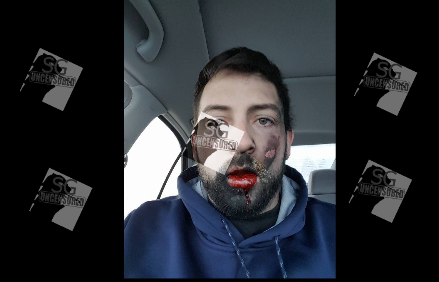 Vape Explode In Guy Mouth. Guy LOST 4 TEETH(Video)