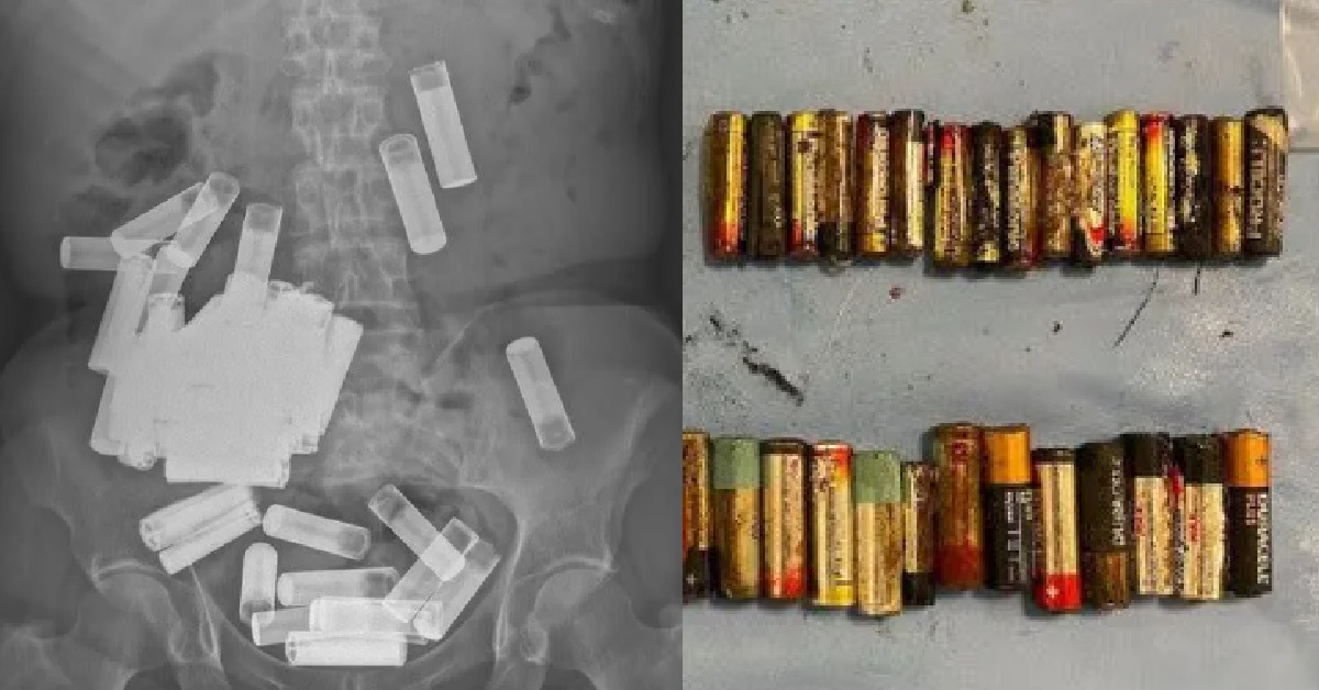 66 Y.O WOMAN SWALLOWED 55 BATTERIES, DOCTORS MANAGED TO REMOVE 46 OF THEM