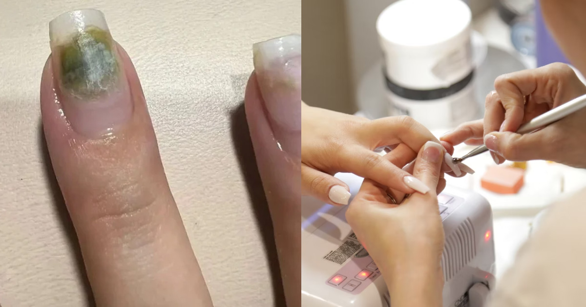 PRC WOMAN GETS INFECTION AFTER MANICURE; WARNS OF UNHYGENIC SALONS